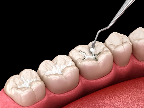 Tooth Fillings: Costs, Types, Procedure & Care
