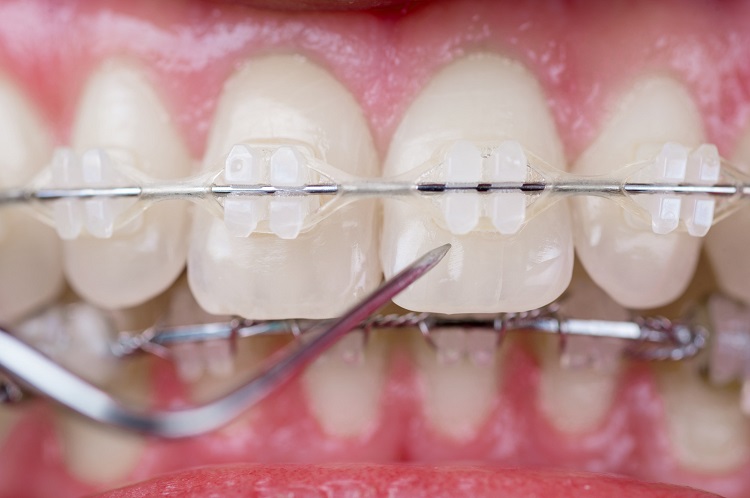 Braces Cost in India: Types, Pricing & Choosing the Right Orthodontist