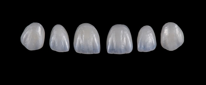 Emax Crowns: Aesthetic and Metal-Free Dental Restorations
