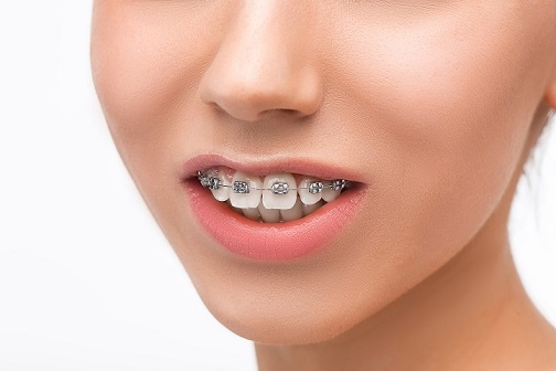 Metal Crown: Types, Benefits, Costs, and Procedure