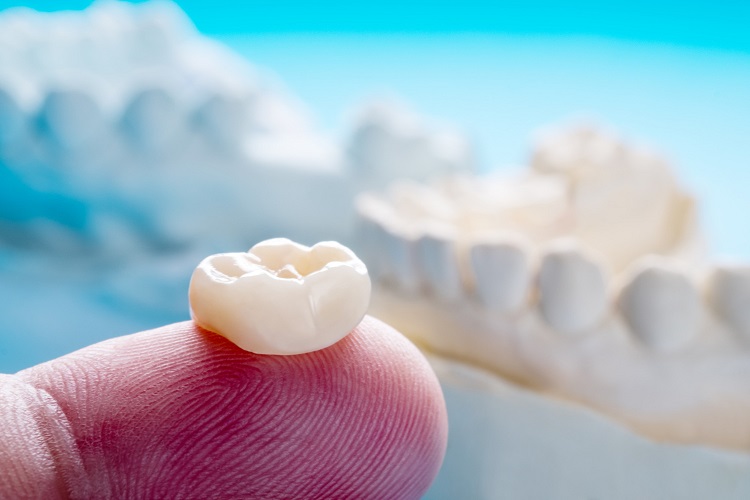 Teeth Cap Types: Choose the Best Options for You