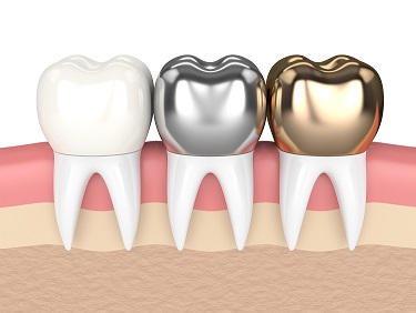 Permanent Teeth Cap Price: Types, Benefits and Cost Breakdown